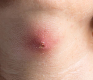 Abszess (Eiterbeule): Ursachen, Symptome & Behandlung