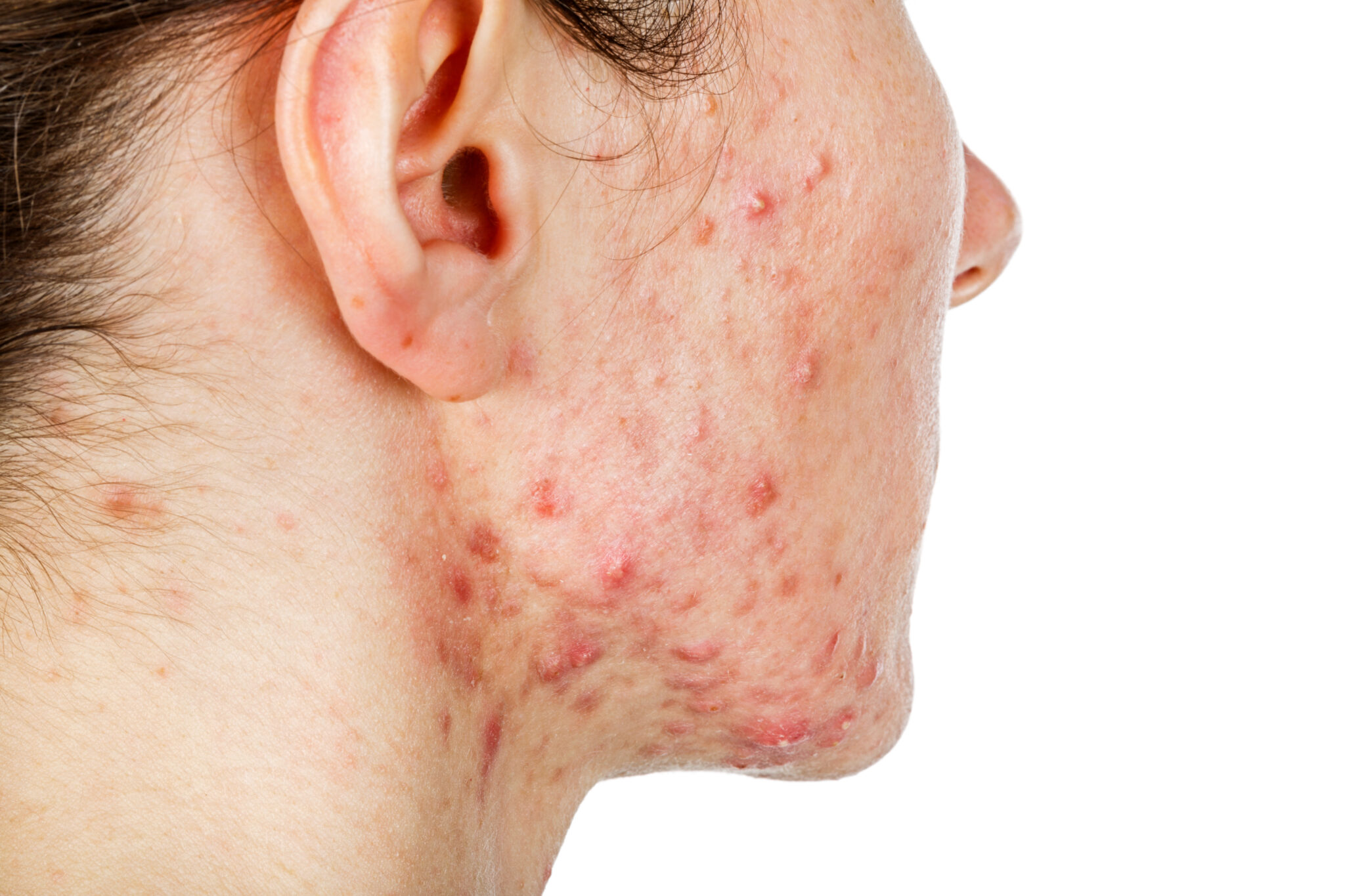 Acne comedonica: Ursachen, Symptome & Behandlung