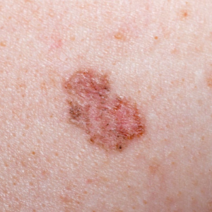 Basaliom (Weißer Hautkrebs): Ursachen, Symptome & Behandlung