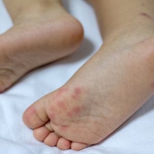 Hand-Fuß-Mund-Krankheit: Symptome & schnelle Behandlung
