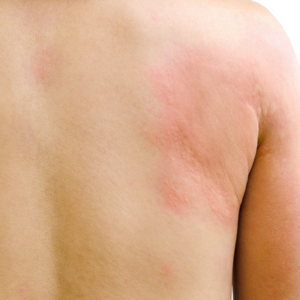 Nesselsucht (Urtikaria): Ursachen, Symptome & Behandlung