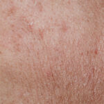 Xerosis cutis: Ursachen, Symptome & Behandlung