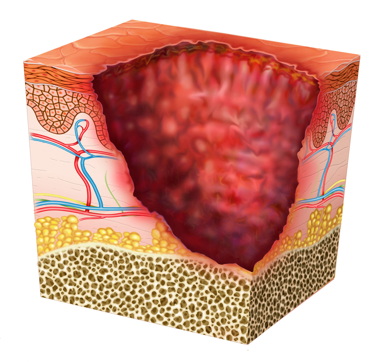 Pyoderma Gangraenosum Typische Symptome And Therapie