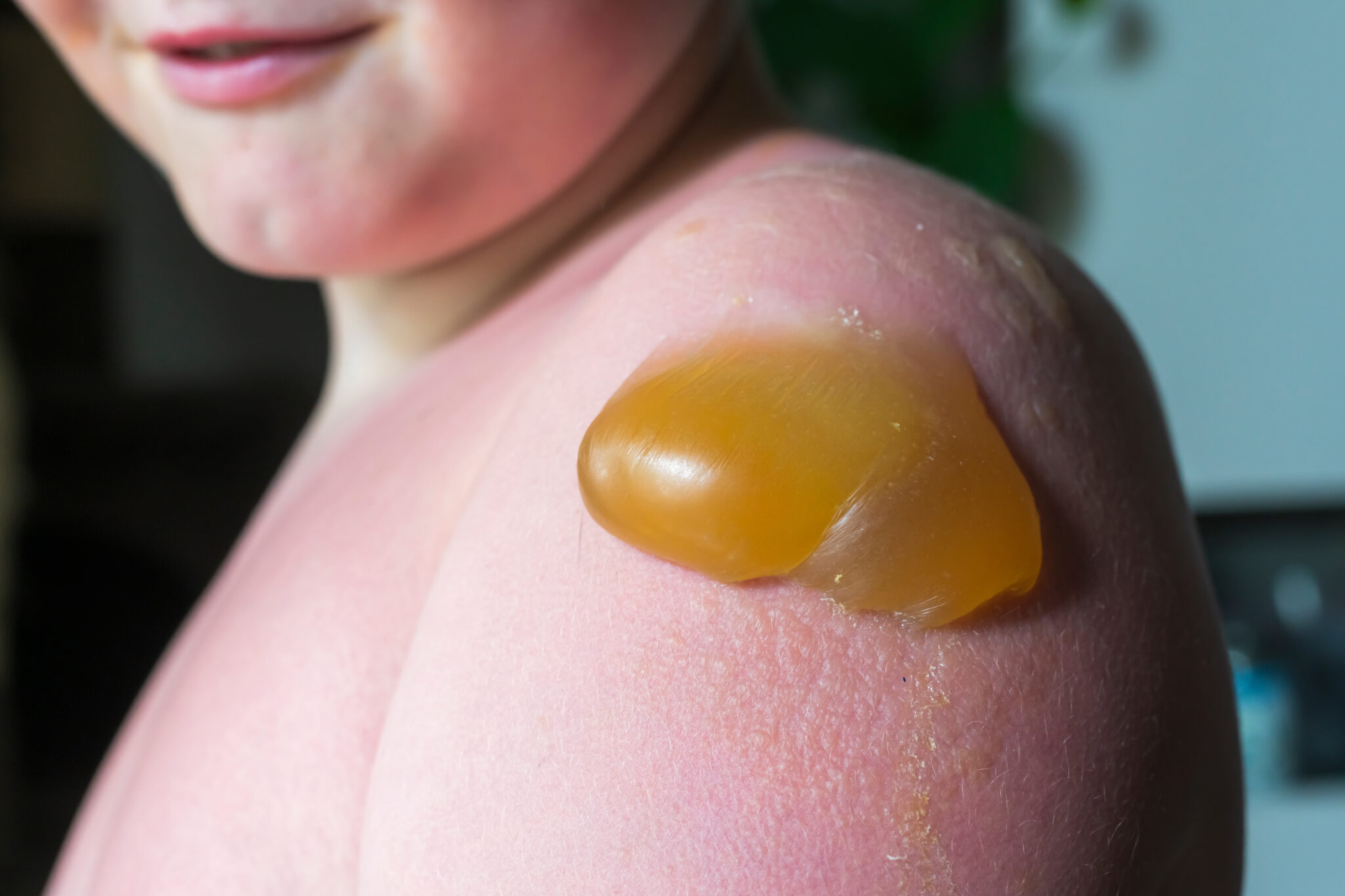 Altersflecken: Ursachen, Symptome & wirksame Behandlung