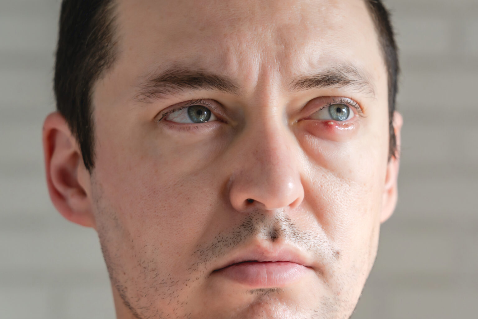 Pyoderma Gangraenosum Typische Symptome And Therapie
