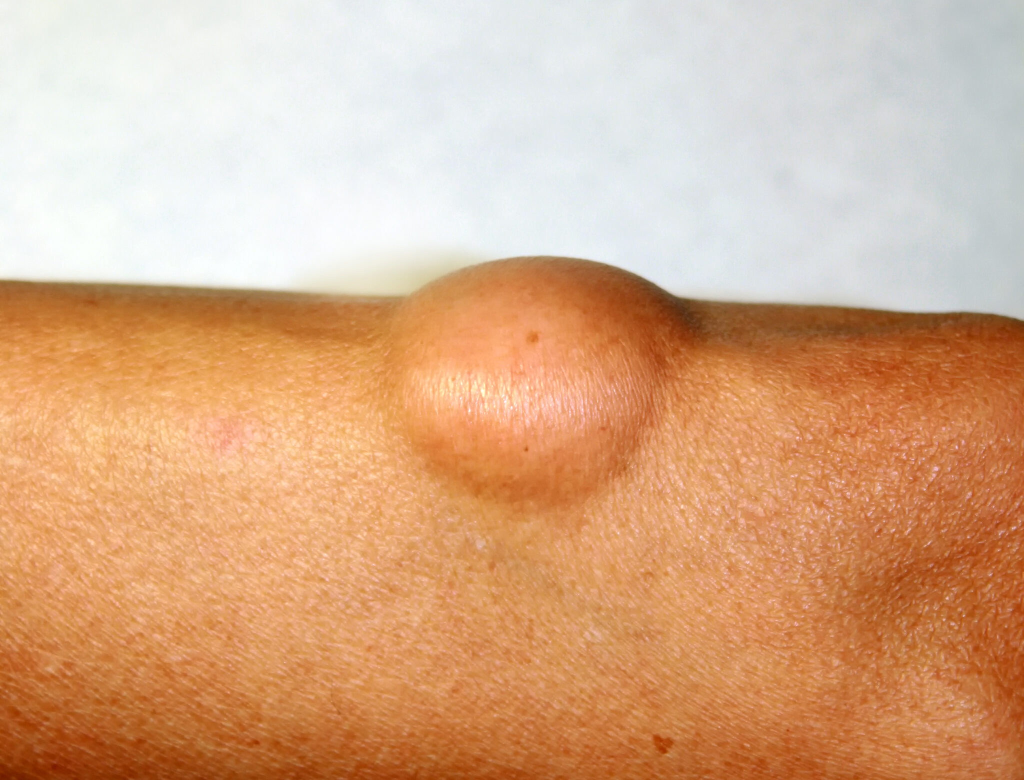 Blaues Muttermal: Symptome, Ursachen & Behandlung