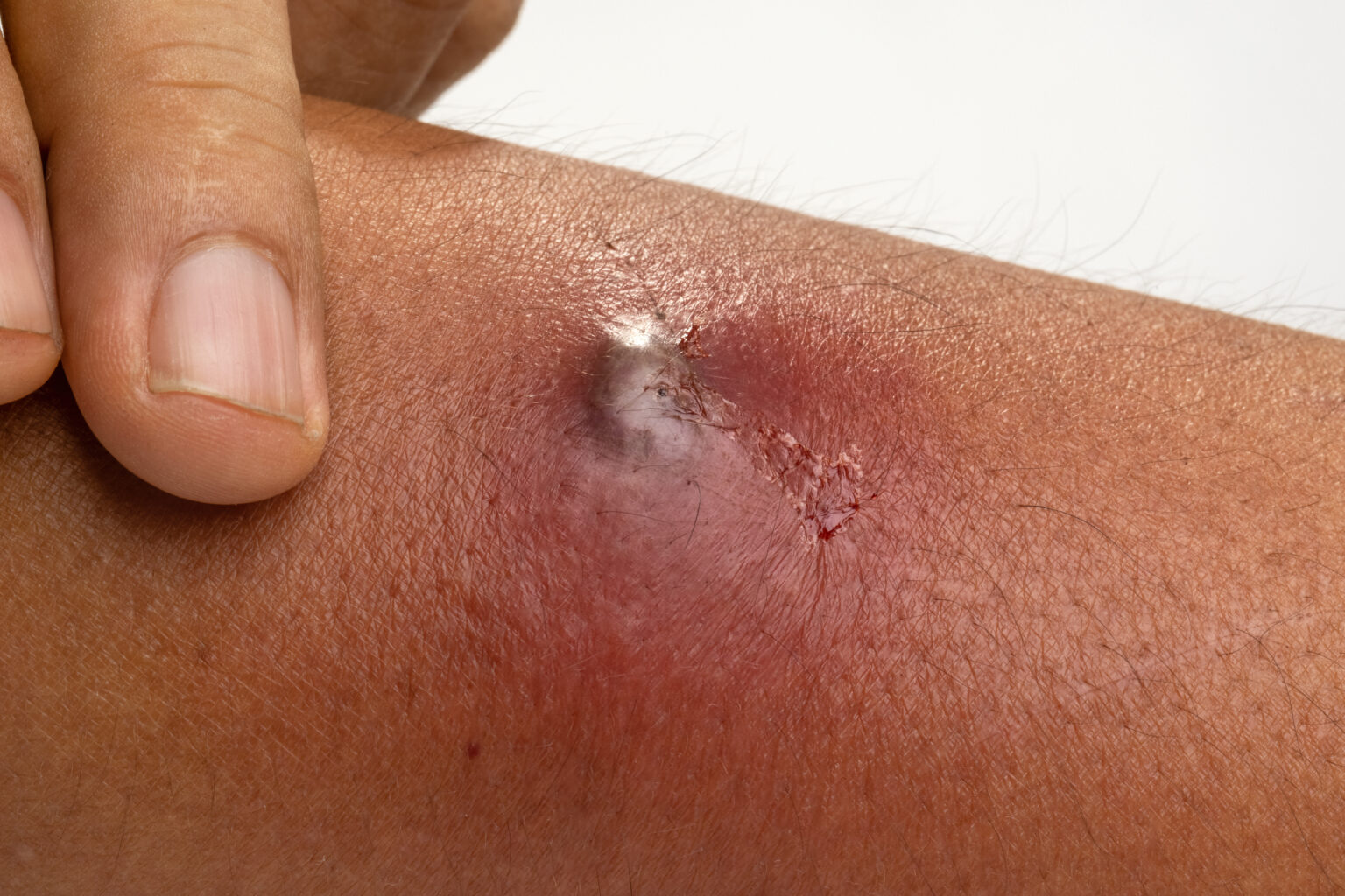 Tripper (Gonorrhoe): Ursachen, Symptome & schnelle Behandlung