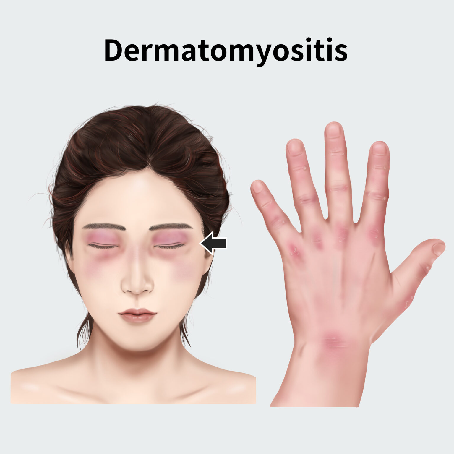 Sonnenbrand (Dermatitis solaris): Symptome & Behandlung